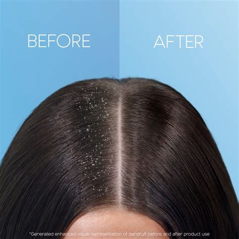 How To Get Rid Of Dandruff From Hair Head And Shoulders Au