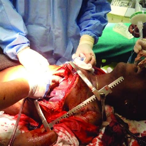 Entrance Edendale Hospital Figure 3 Emergency Room Thoracotomy For