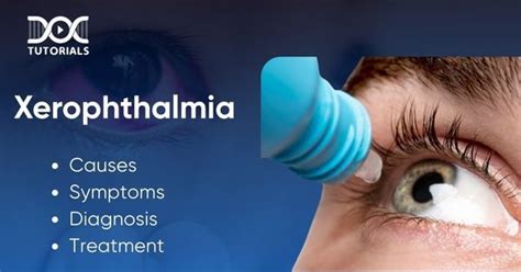 Xerophthalmia Causes Symptoms Diagnosis And Treatment