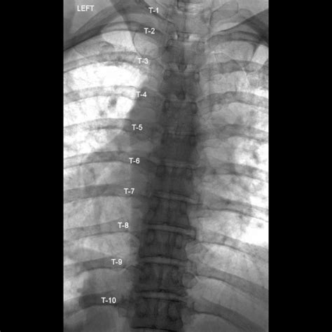 Selective Nerve Root Block Thoracic Spine Clinical Tree