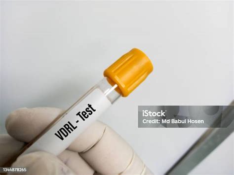 시험관 벡터에서 Vdrl 검사를 위한 혈액 샘플 매독 검사 개념에 대한 스톡 사진 및 기타 이미지 개념 개념과 주제 건강