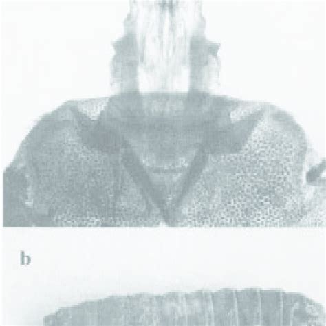 Pdf Enteric Myiasis By Hermetia Illucens Diptera Stratiomyidae In