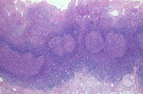 Normal Lymphoid Tissues Part 4 7
