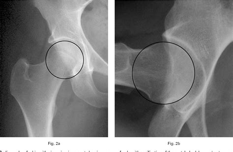 Femoroacetabular Impingement Fai Acetabular Impingeme