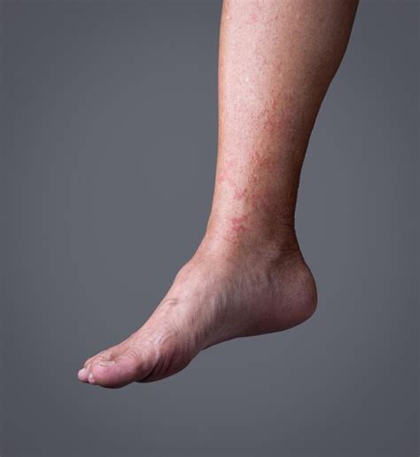 Premium Photo Strong Allergic Rashes On The Leg On Gray Background