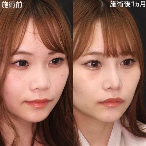 スッと鼻筋が通り、より整ったお顔立ちに｜症例写真・ビフォーアフター｜美容整形･美容外科のtaクリニックグループ