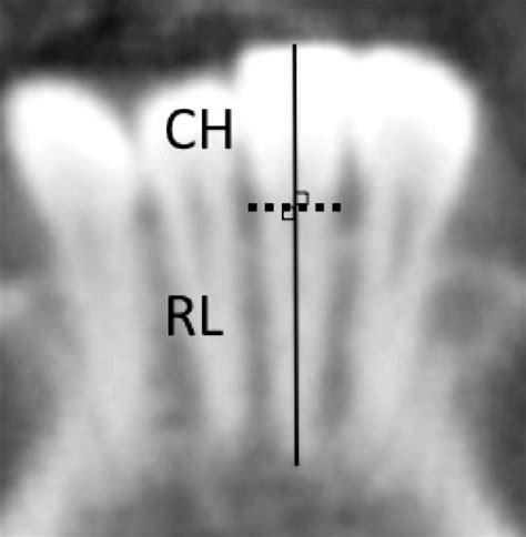 Tooth Size Measurements On Cbct Images Ch Indicates Crown Height Rl