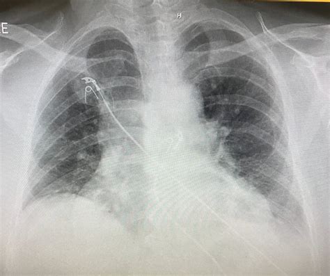 When Should You Get A Ct Scan On A Stemi Patient To Rule Out Aortic