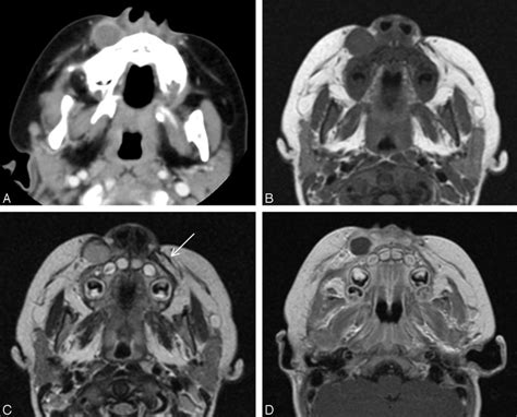 Case 3 Nodular Fasciitis Involving The Right Perinasal Area In A