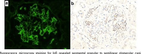 Figure 1 From Segmental Nell 1 Membranous Nephropathy Complicating Tiopronin Therapy Semantic