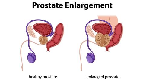 What Causes Enlarged Prostate At Young Age