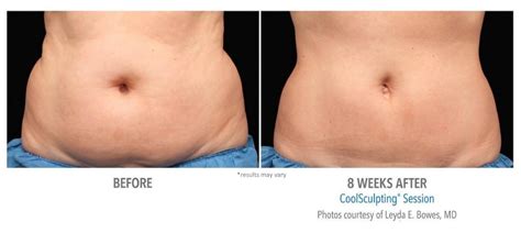 Coolsculpting Before And After Real Patient Photos Vein And Laser