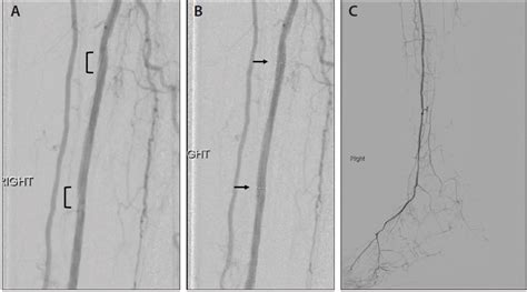 Case Report Treatment Of Severe Calcific Cli With Atherectomy Scoring