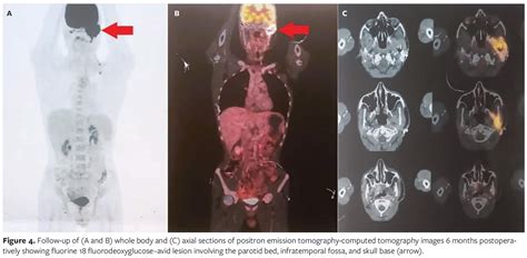 Multimodality Management Of Locoregionally Extensive Marjolin Ulcer A
