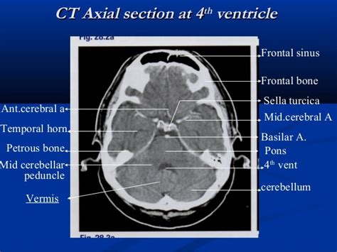 Radiological Anatomy And Techniques Of The Ventricular System
