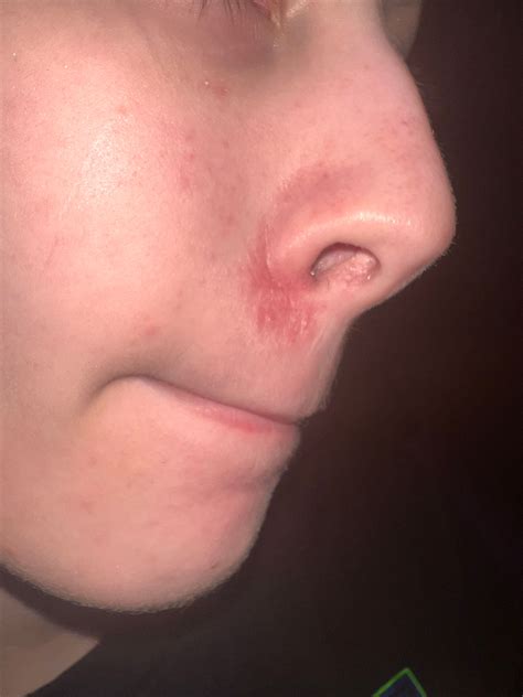 Dry Flakey Skin Around Nose Beauty Insider Community