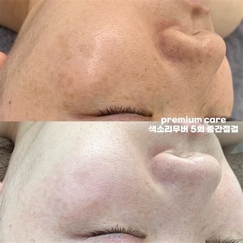새김브로우 미백 맛집 인정🙌🏻 퍼스널스킨트리트먼트 프리미엄케어 5회차 전후 사진입니다 미백과수분밸런스에 포커스를 맞춰 해드렸더니 효과가 역시 좋네요 프리미엄