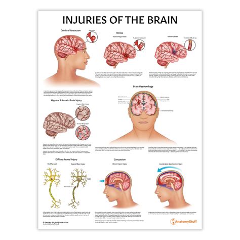 Traumatic Brain Injury Chart Disparities In Casemix Acute