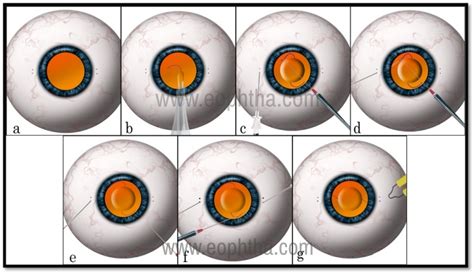 Scleral Fixated Intraocular Lens Implantation A Comprehensive Review