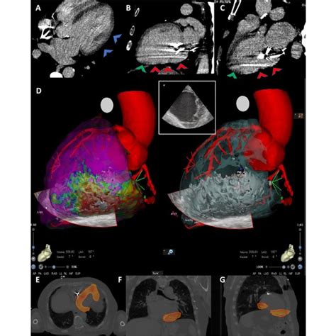 Ct Imaging With Myocardial Fibrosis Evaluation Integrated