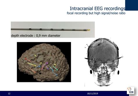ppt exploring epilepsy through electrophysiology in neuroscience