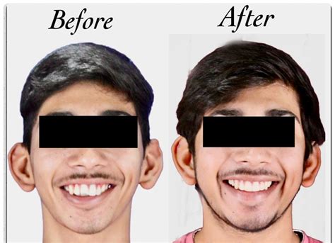 Dental Braces Jaldental