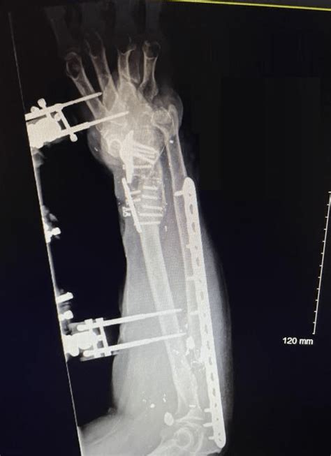 Worst Foosh Injury Ive Ever Seen Rradiology
