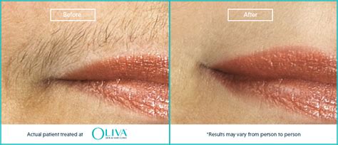 Laser Hair Removal For Upper Lip And Chin Procedure And Packages