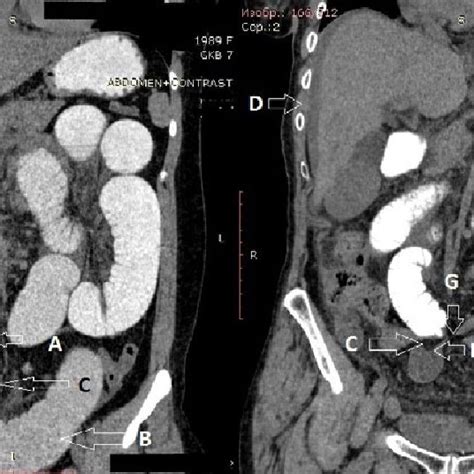 Pdf Acute Adhesive Small Bowel Obstruction Laparotomy Or Laparoscopy