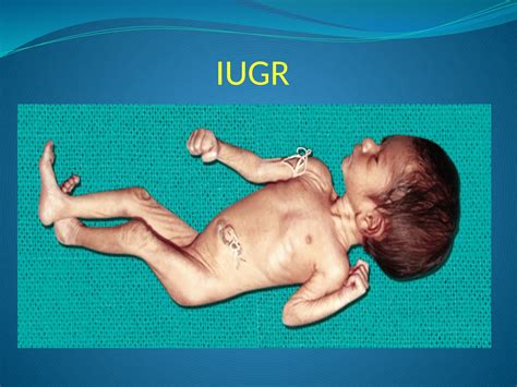 Iugr Intra Uterine Growth Restriction Pptx
