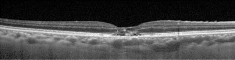 A Case Of Non Neovascular Pachychoroid Disease With Hrm And Srf Sd Oct