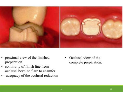 Posterior Partial Veneer Crowns Kelly Pptx