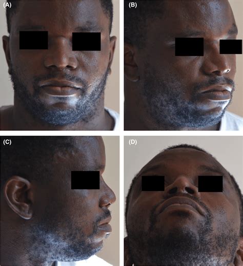A‐d Two Years Postoperative Photographs Of The Patient Download