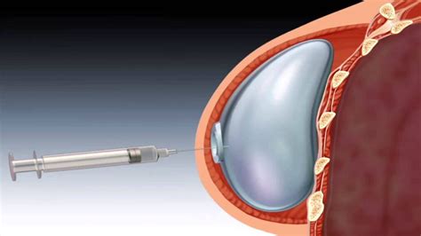 Mastectomy Breast Tissue Flap Surgery Vs Implants Lost Temple