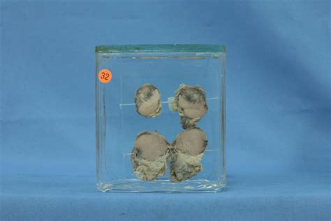 内分泌 70 32 甲状腺未分化癌 病理标本博物馆 复旦大学基础医学院