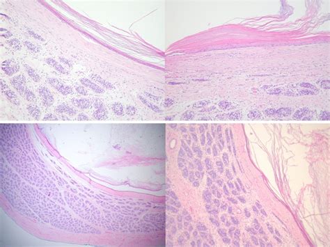 Paediatric Benign Cystic Monodermal Testicular Teratoma Bmj Case Reports