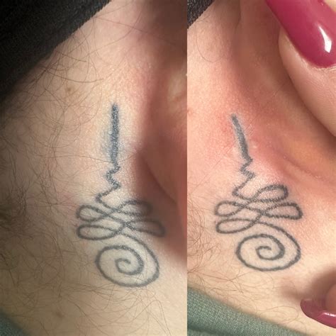 Tattoo Ink Spreading Under Skin