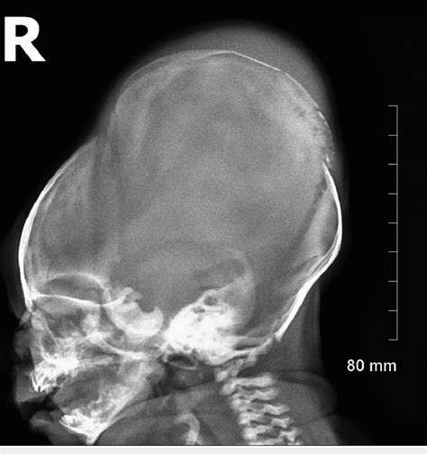 Lateral View X Ray Image Of The Neonate Within Hours Of Delivery