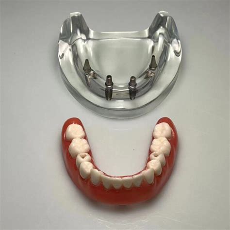 Translucent Pathological Implant Model 4599 February 2025 Dental