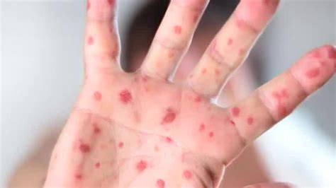 Sarampión Cuáles Son Los Síntomas Y Sus Consecuencias A Largo Plazo