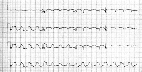 Ecg Revealing Marked Pr Segment Elevation In The Inferior Leads And