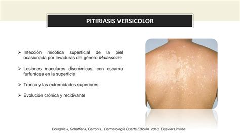 Solution Pitiriasis Versicolor Studypool