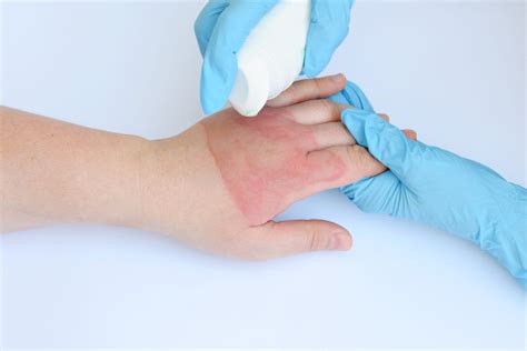 Understanding The Long Term Effects Of Burn Injuries In Texas