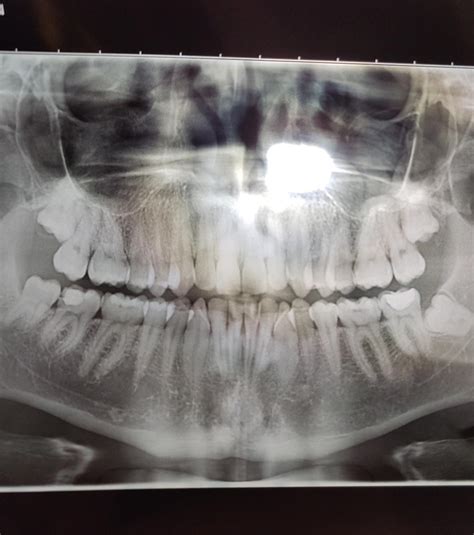 Upper Wisdom Teeth Do They Need Removal R Wisdomteeth