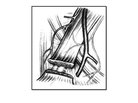 Neck Dissection Part 2 Pptx