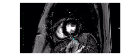 Short Axis Left Ventricular Late Gadolinium Enhancement On Cardiac