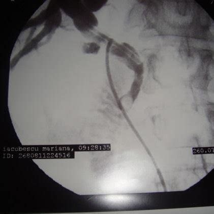 Intraoperative Cholangiography Showed A Large Stone Impacted In The Download Scientific Diagram