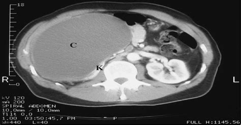 Laparoscopic Deroofing Of A Renal Cyst The Hidden Invasion Surgical