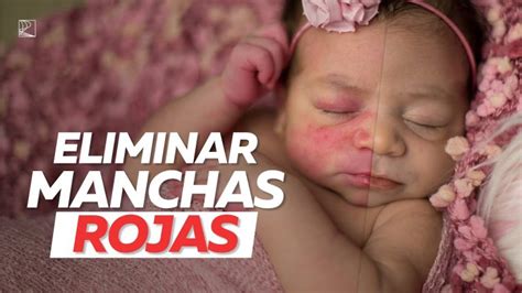 Alerta Bebé Presenta Pintitas Rojas En Su Piel ¿qué Podría Ser 2025