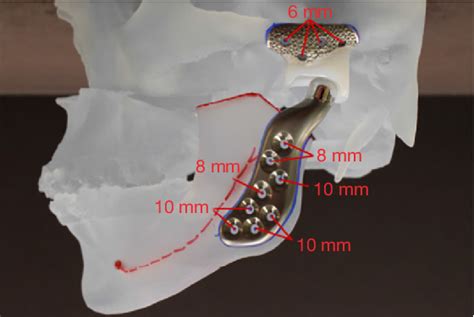 Left Sided Tmj Tjr On A Stereolithographic 3d Skull Model Tmj Download Scientific Diagram